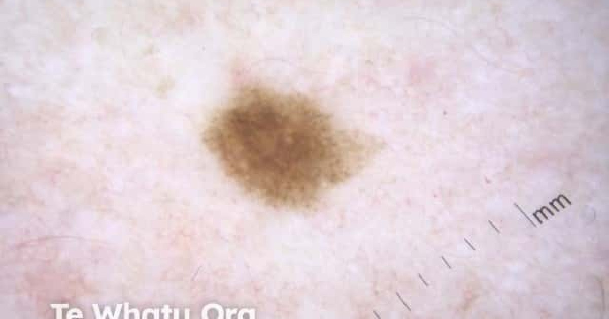 Melanocytic naevus image