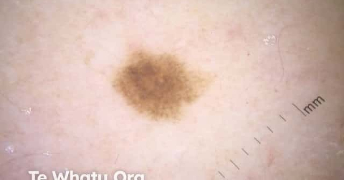 Melanocytic naevus image