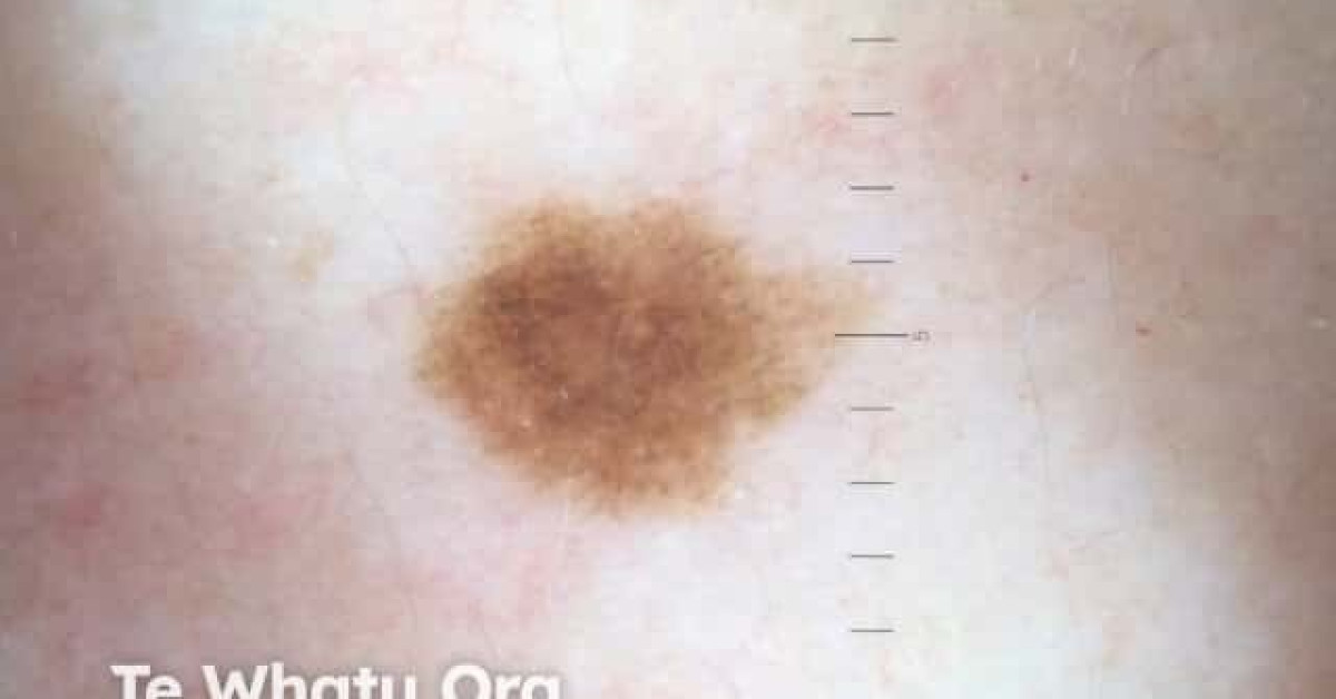 Melanocytic naevus image