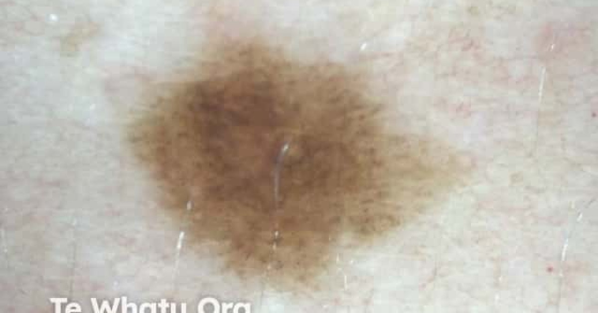 Melanocytic naevus image