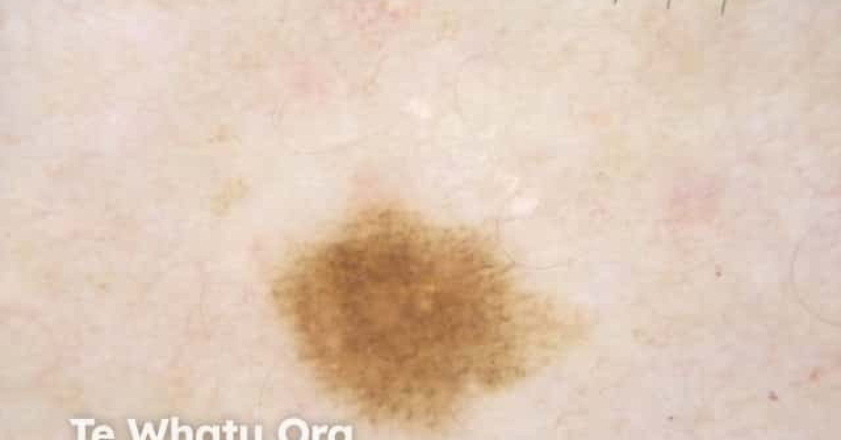 Melanocytic naevus image