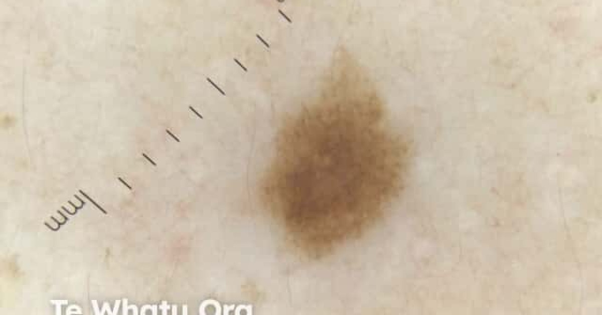 Melanocytic naevus image