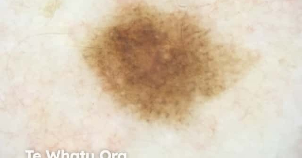 Melanocytic naevus image