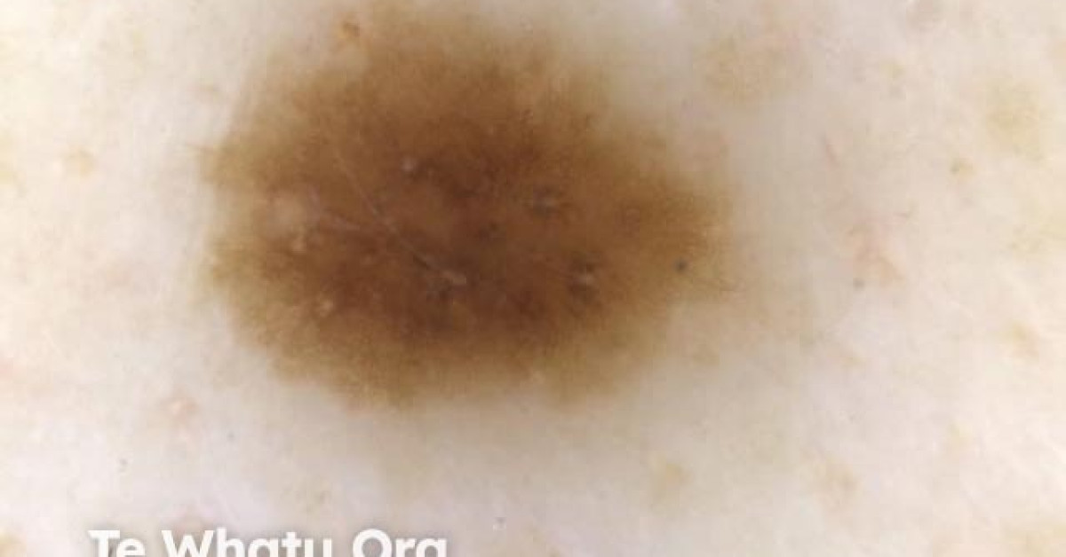 Melanocytic naevus image