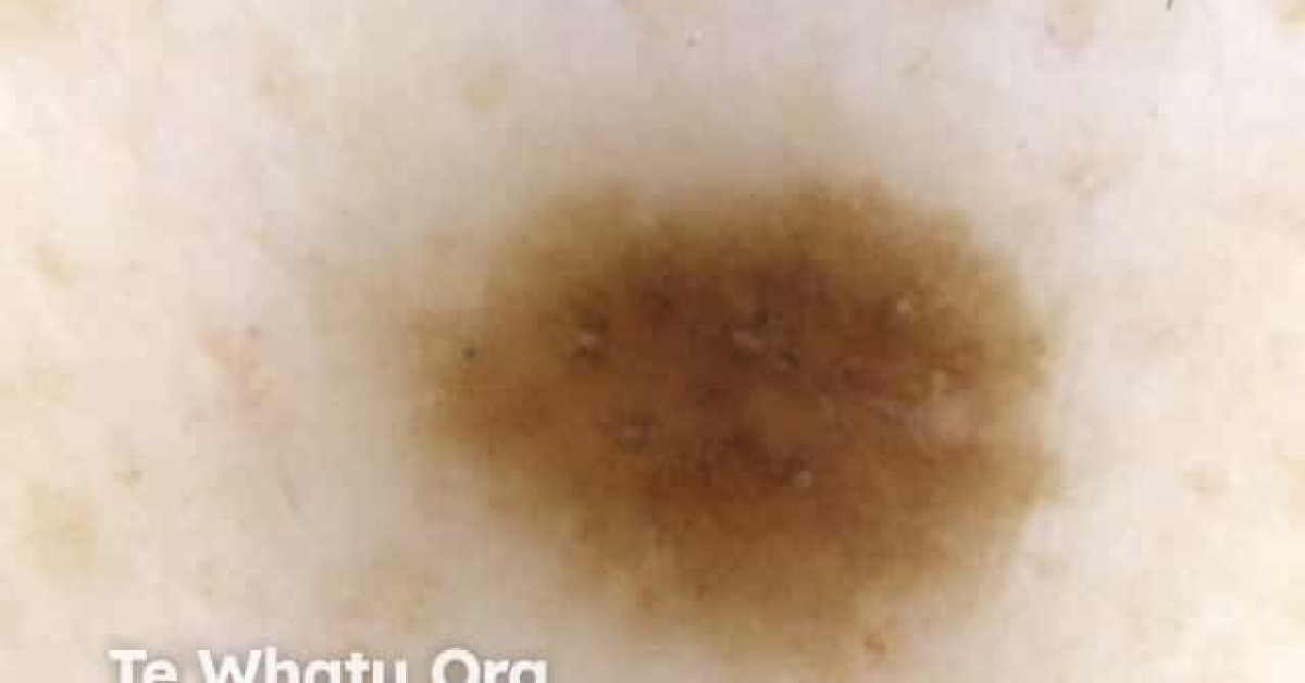 Melanocytic naevus image