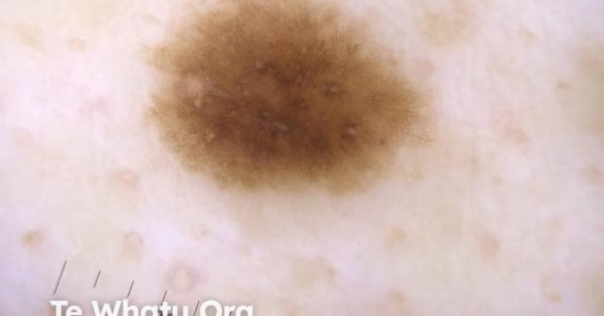 Melanocytic naevus image
