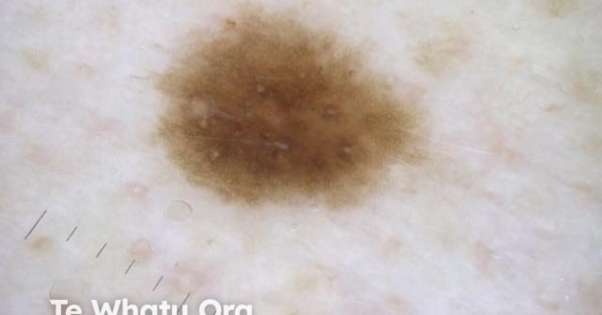 Melanocytic naevus image