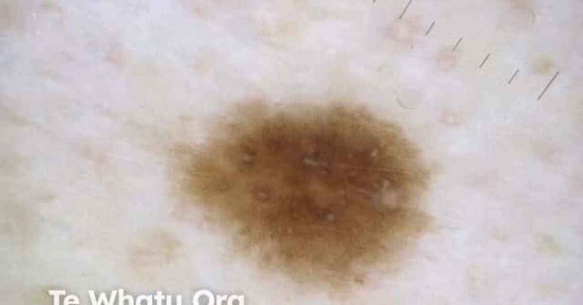 Melanocytic naevus image