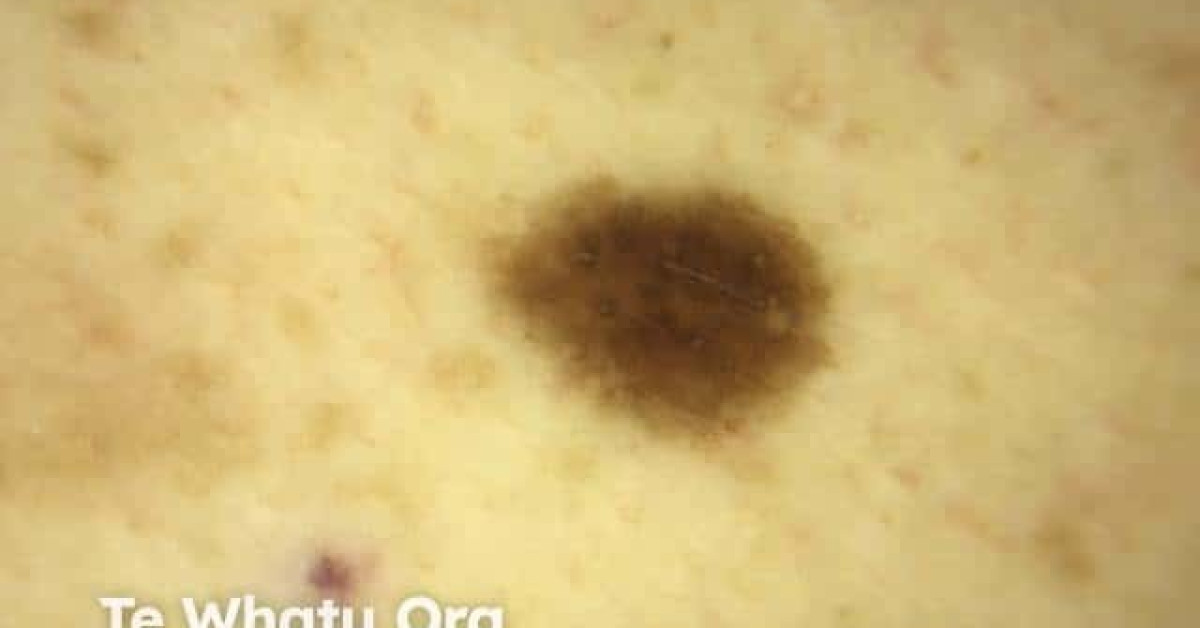 Melanocytic naevus image