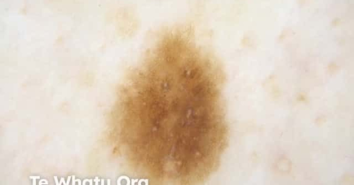 Melanocytic naevus image