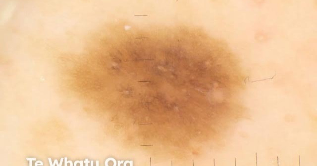 Melanocytic naevus image