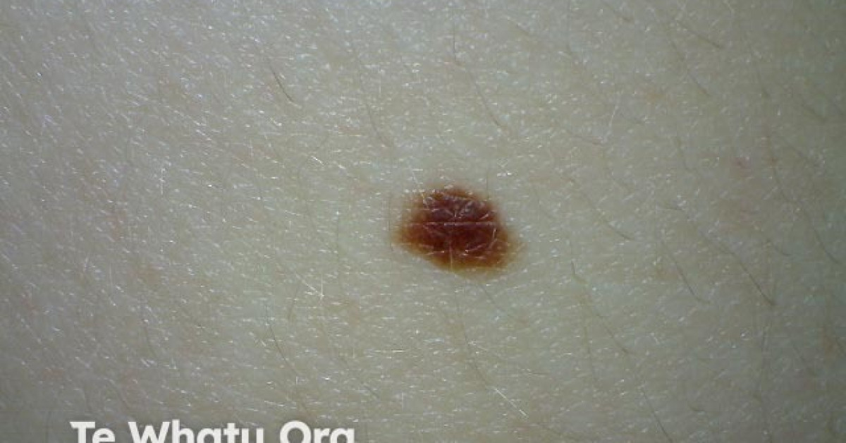 Melanocytic naevus image