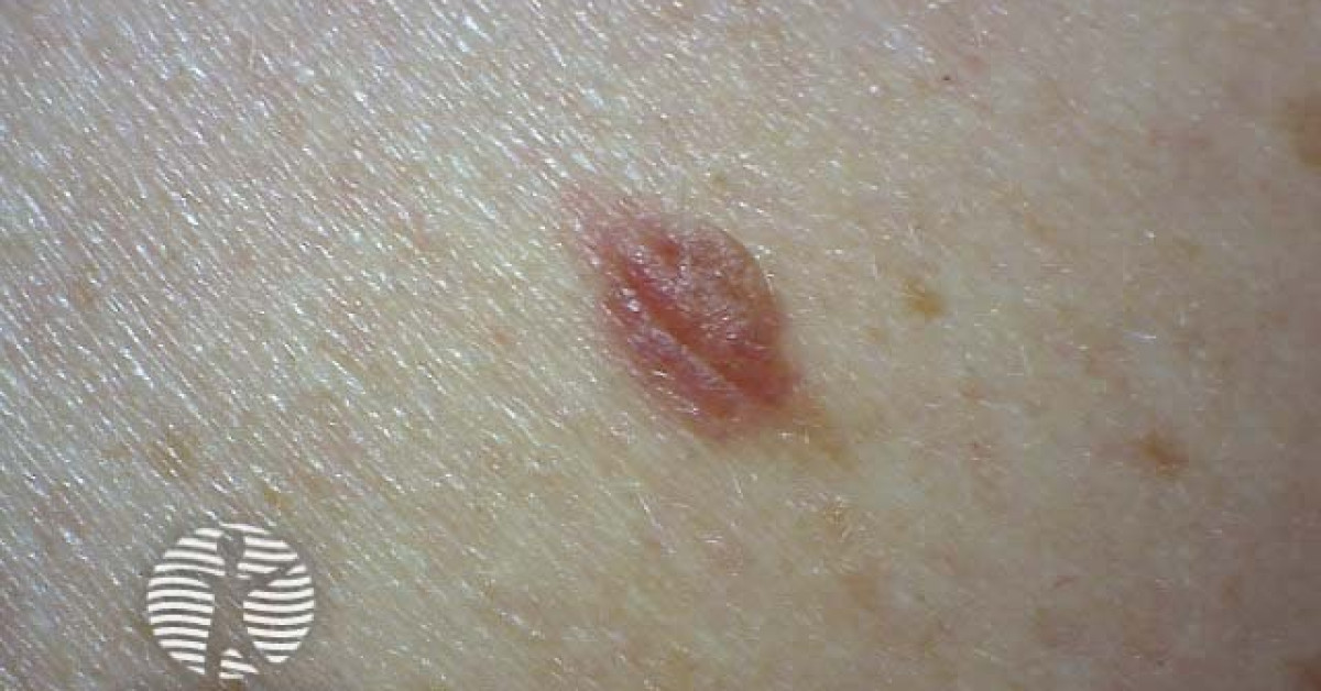 Melanocytic naevus image