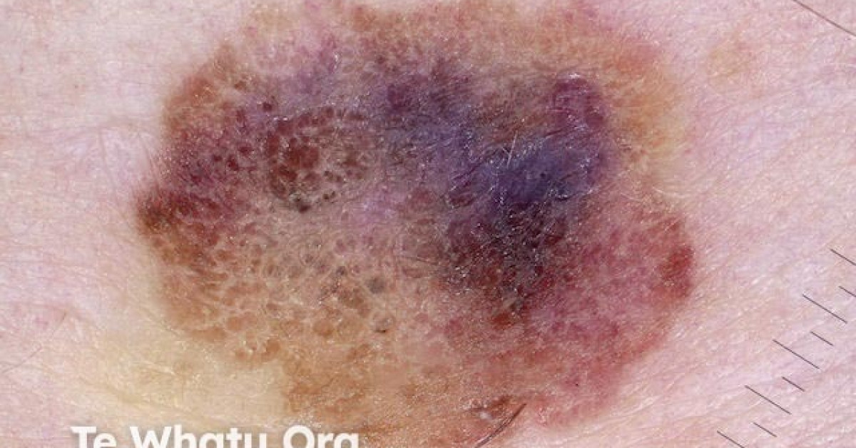 Melanoma in situ image