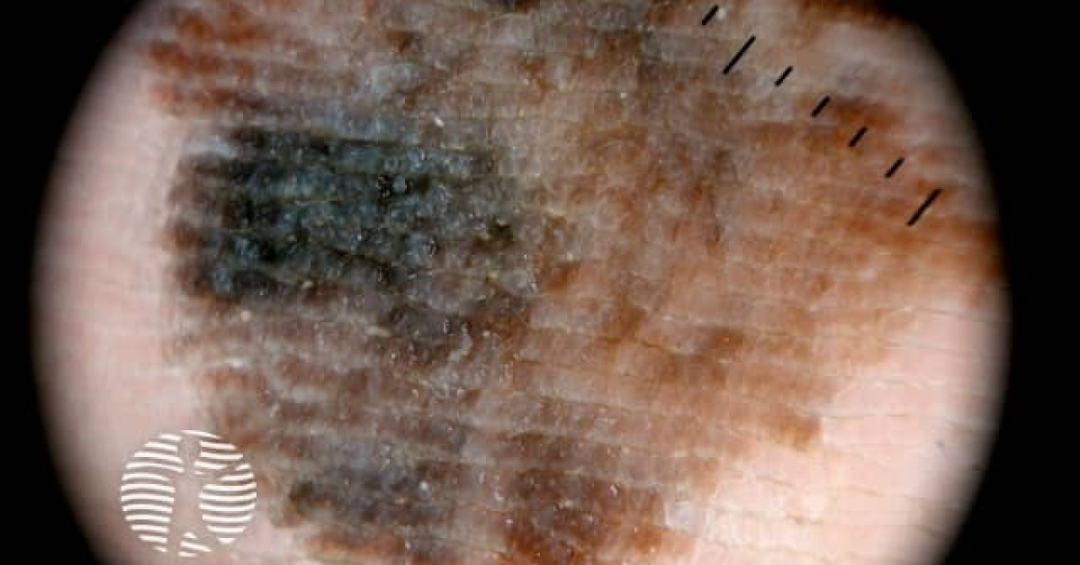 Acral lentiginous melanoma dermoscopy image