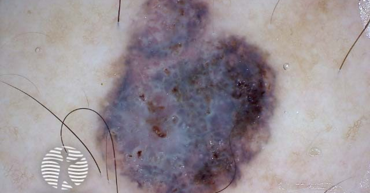 Melanoma dermoscopy image