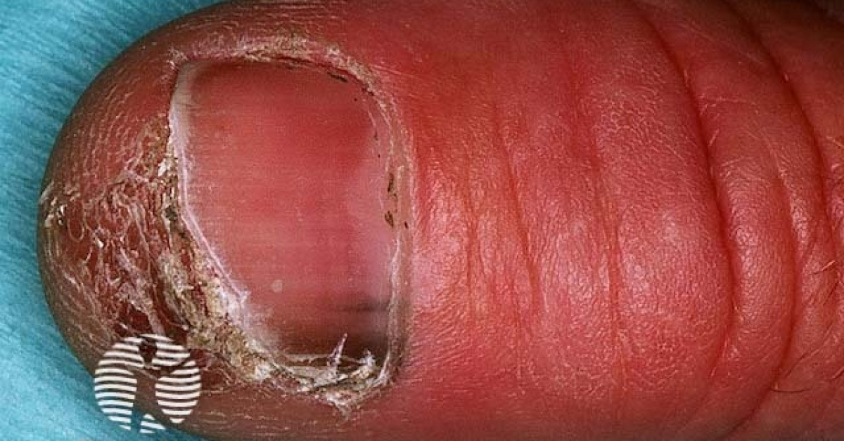 Subungual melanoma image