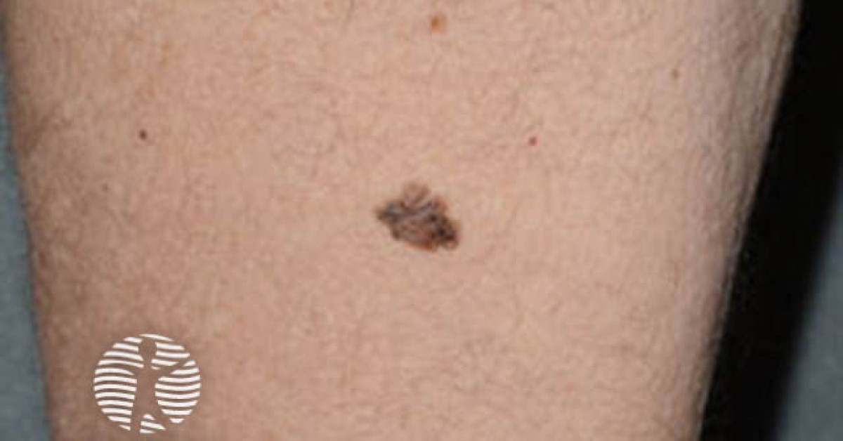 Superficial spreading melanoma image