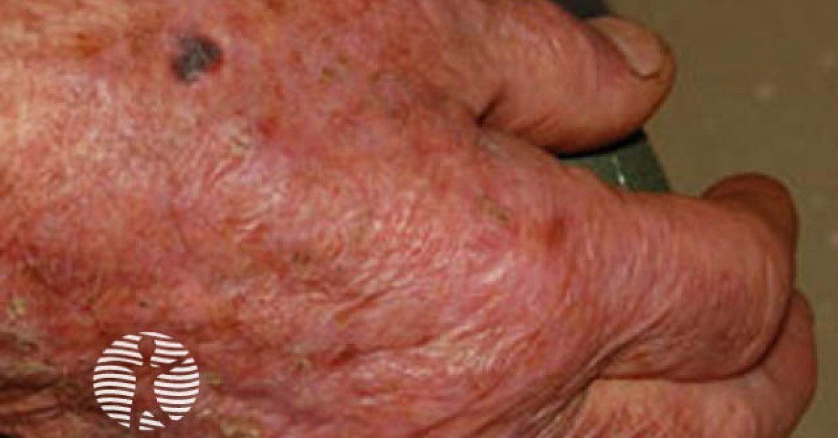 melanoma sun damage image