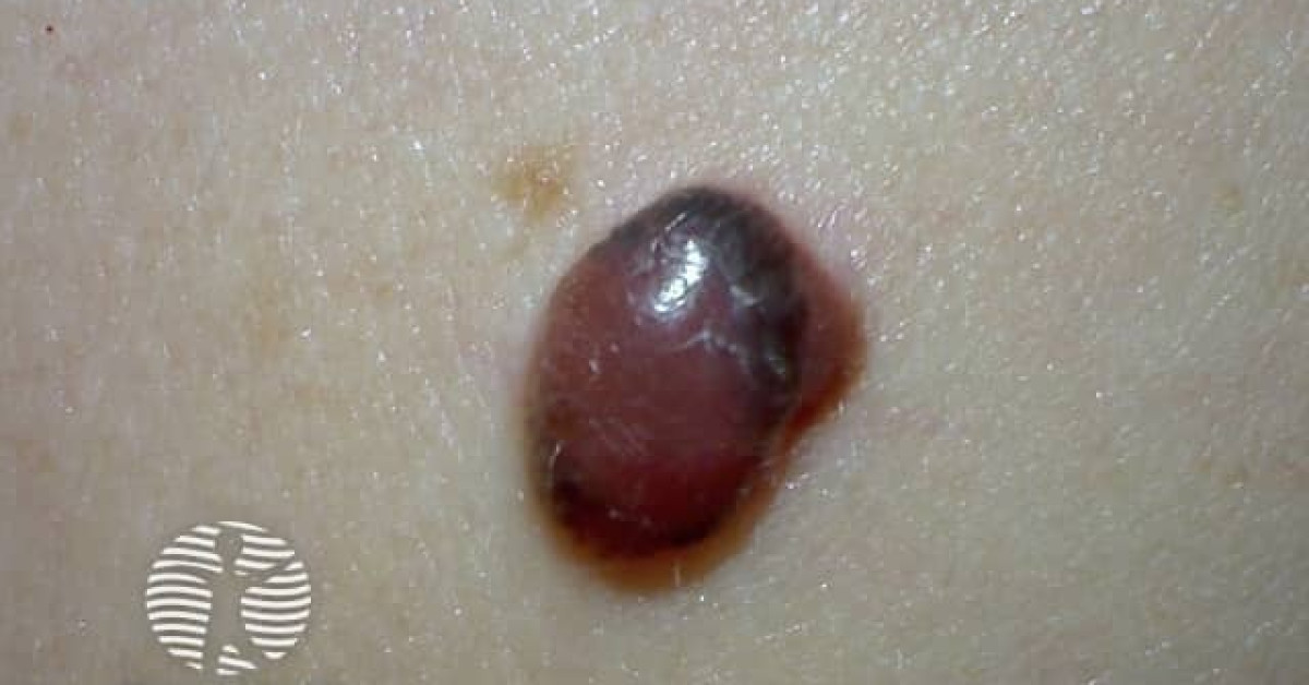 Nodular melanoma image