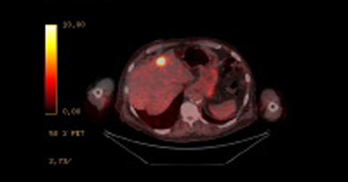 Fused PET/CT image of liver metastasis image