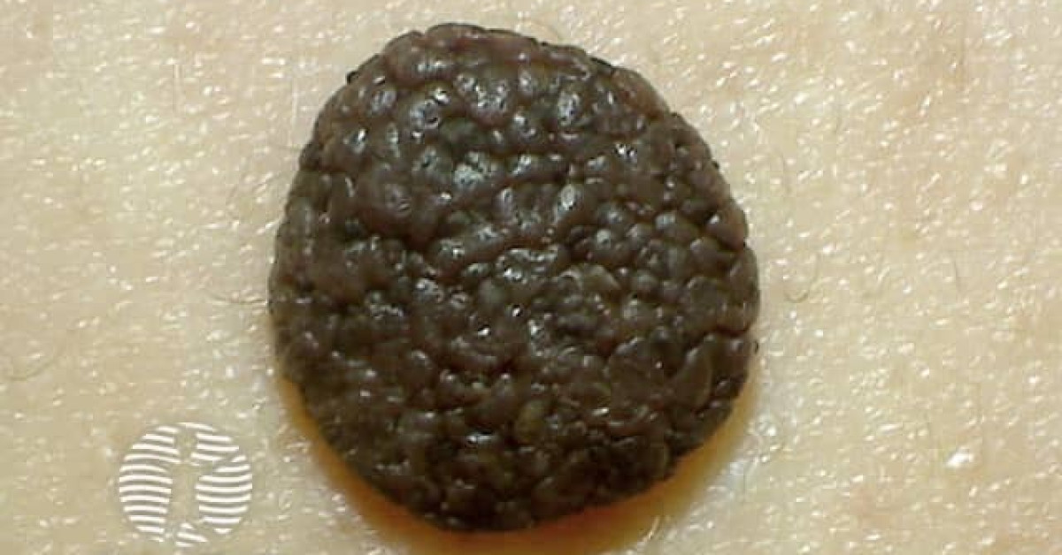 Papillomatous dermal naevus image