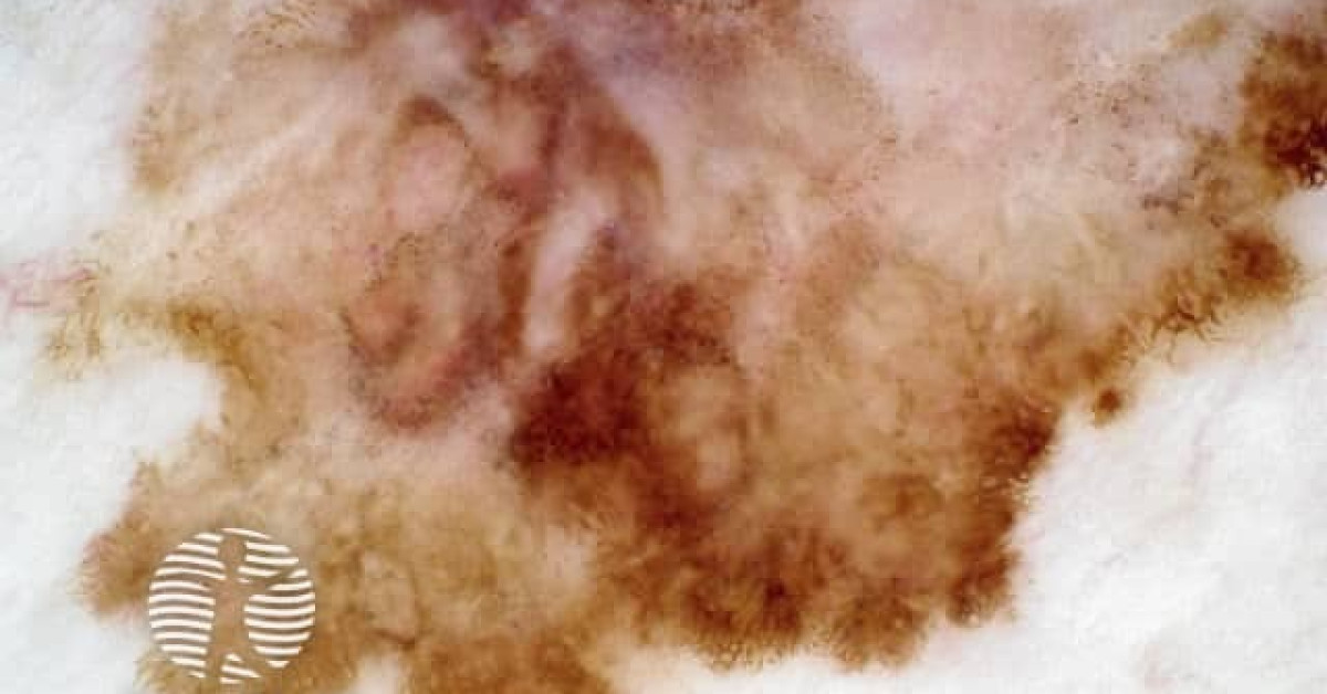 0.4 mm thick superficial spreading melanoma dermoscopy image