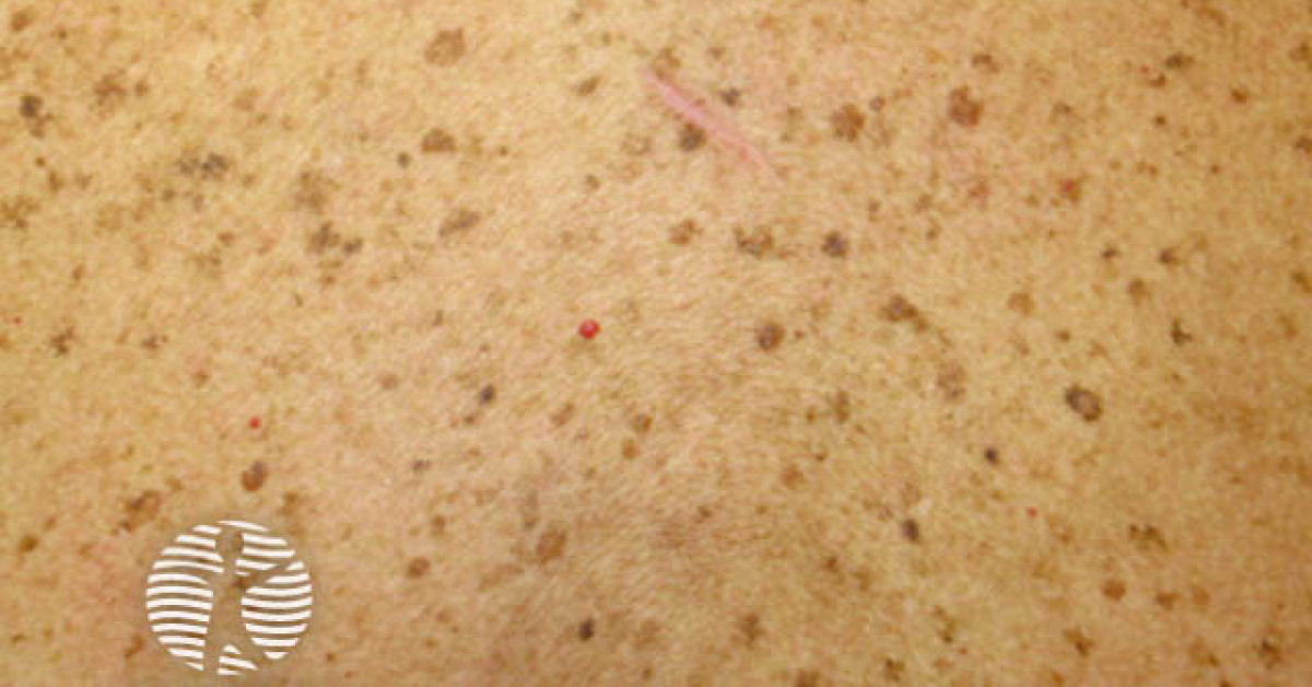 solar lentigines image