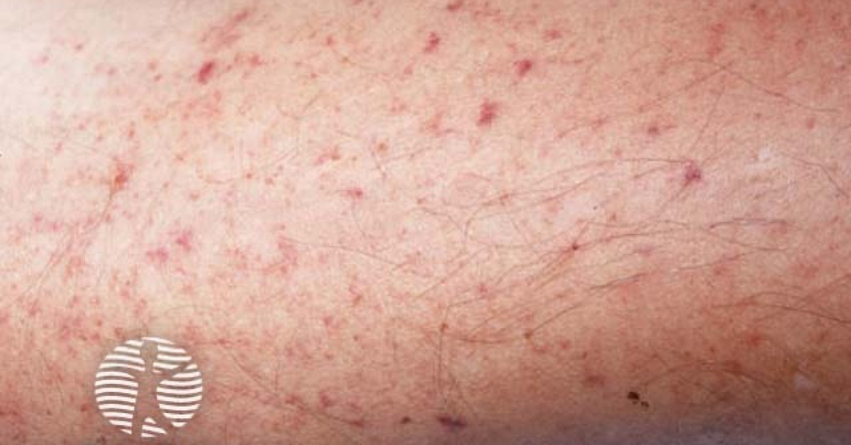 Neisseria Meningitidis Petechial Rash Cause