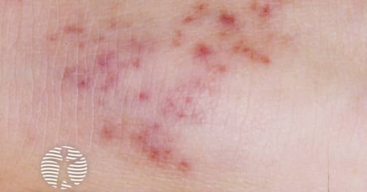 Petechiae due to meningococcal disease image