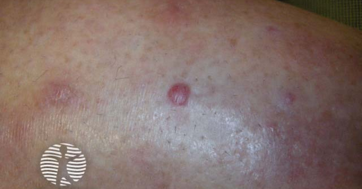 Metastatic melanoma image