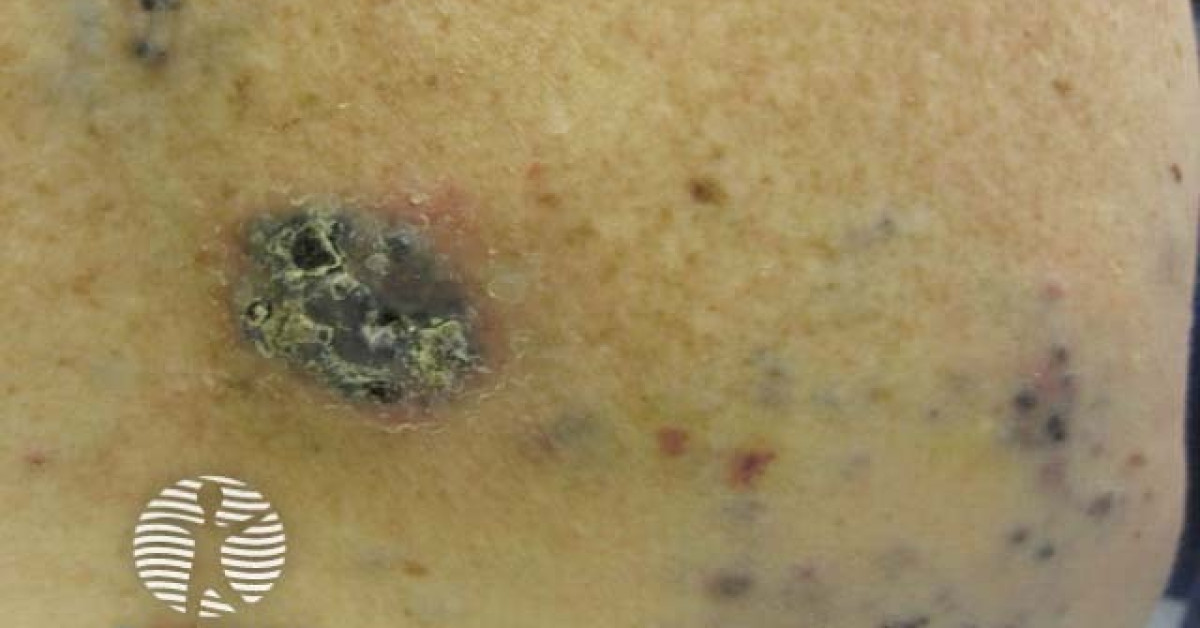 Metastatic melanoma image