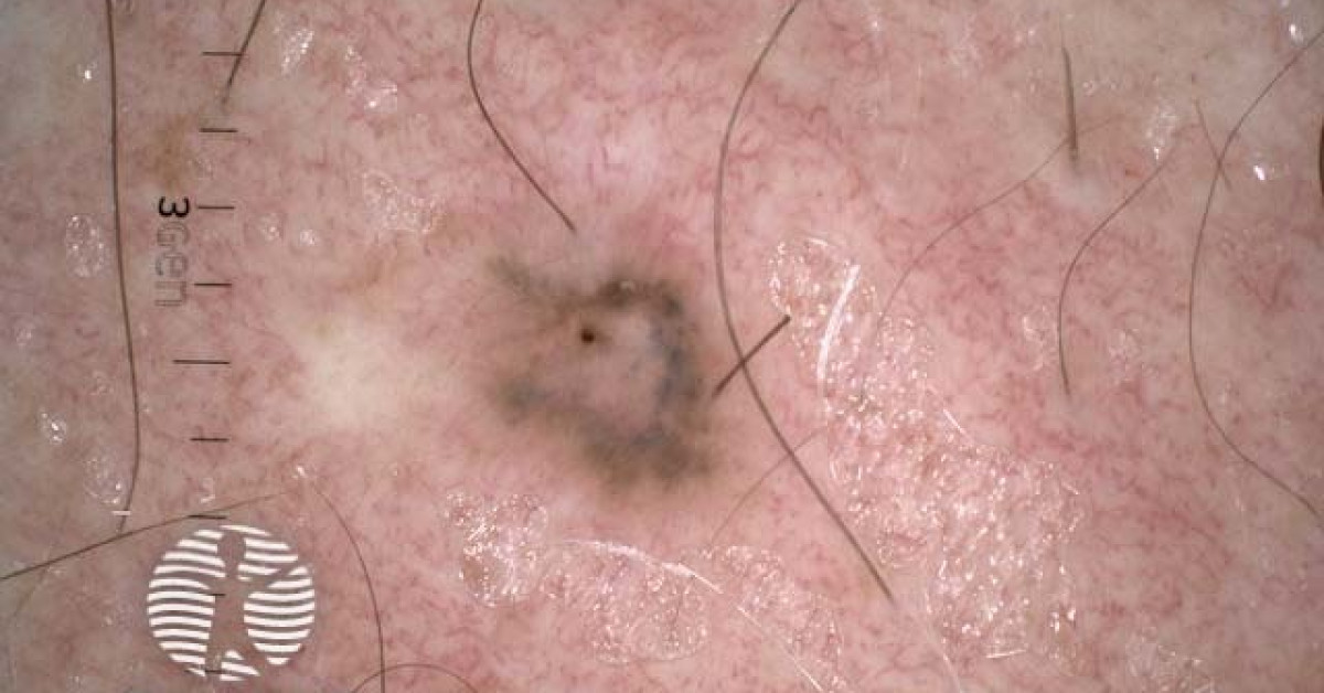 Metastatic melanoma dermoscopy image