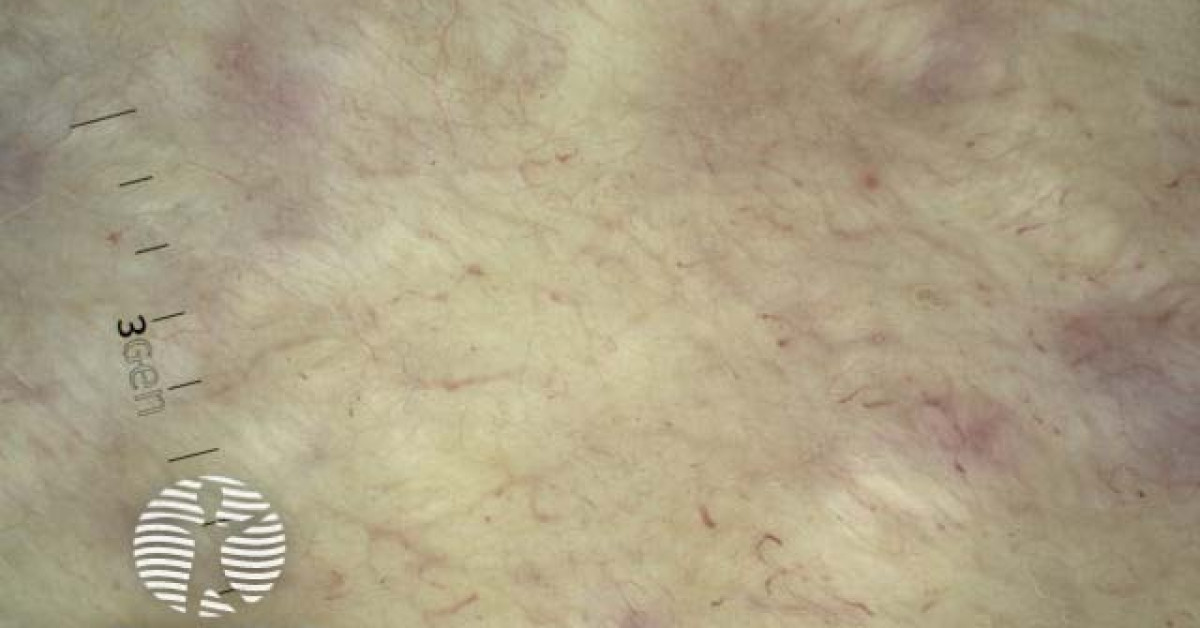 Metastatic melanoma dermoscopy image