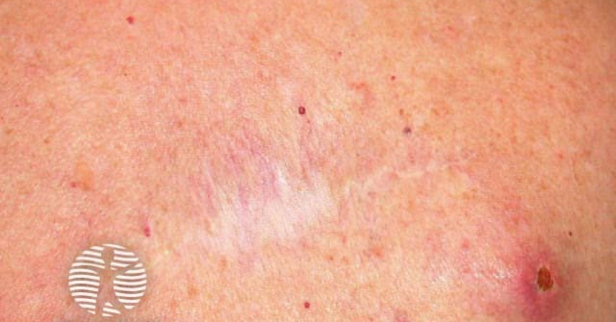 Metastatic melanoma image
