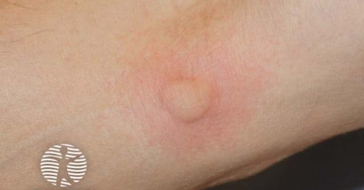 Mosquito bite image