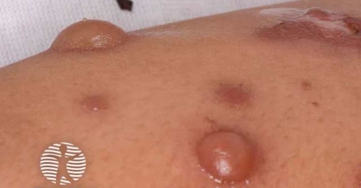 Bullae due to mycoplasma image