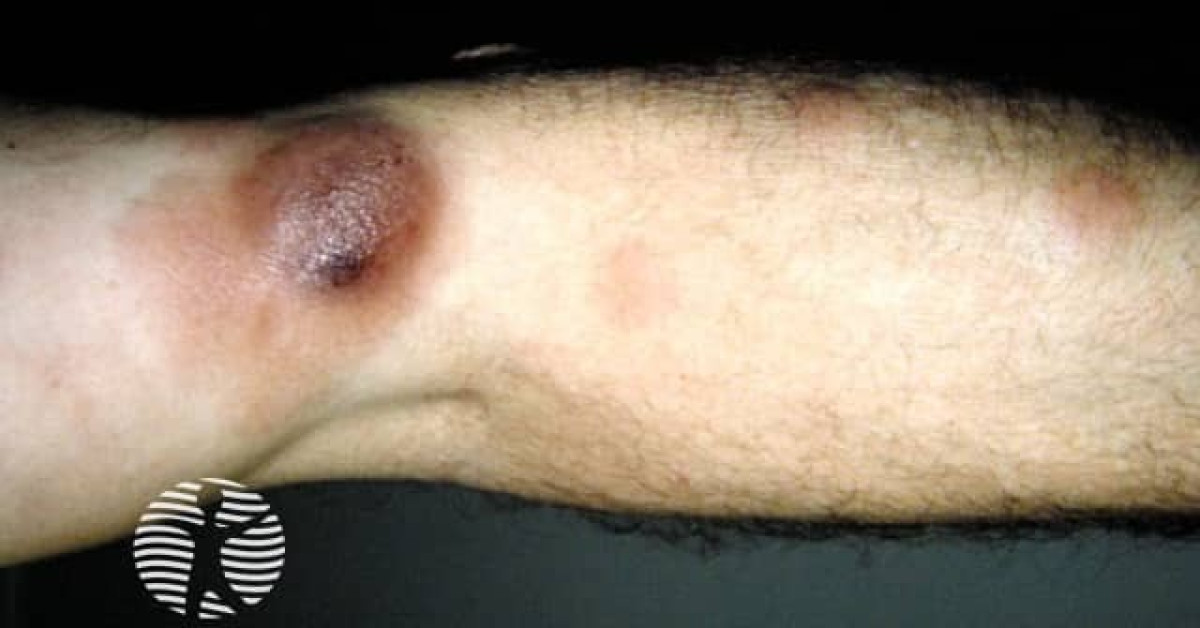 Tumour stage mycosis fungoides image