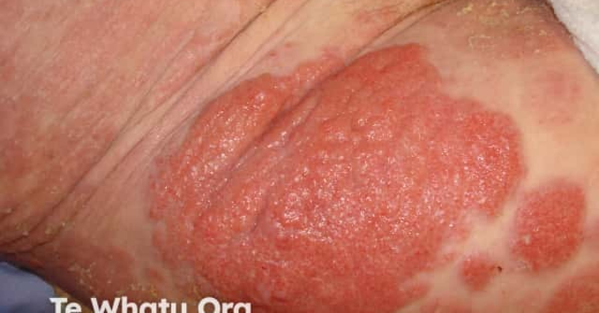 Plaque stage mycosis fungoides image