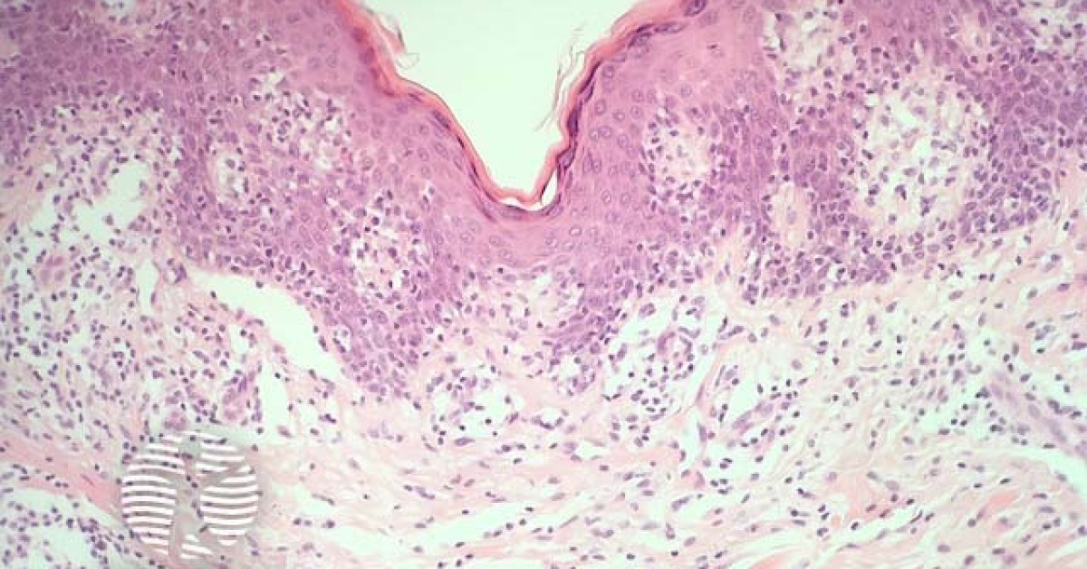 Mycosis fungoides image
