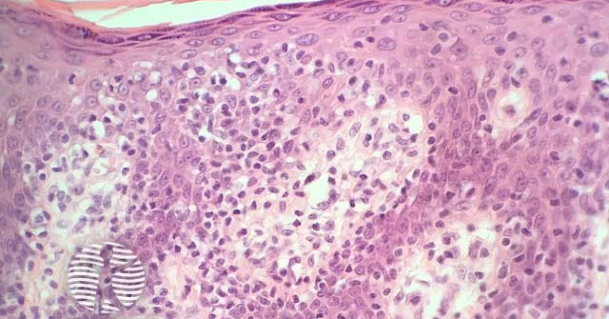 Mycosis fungoides image