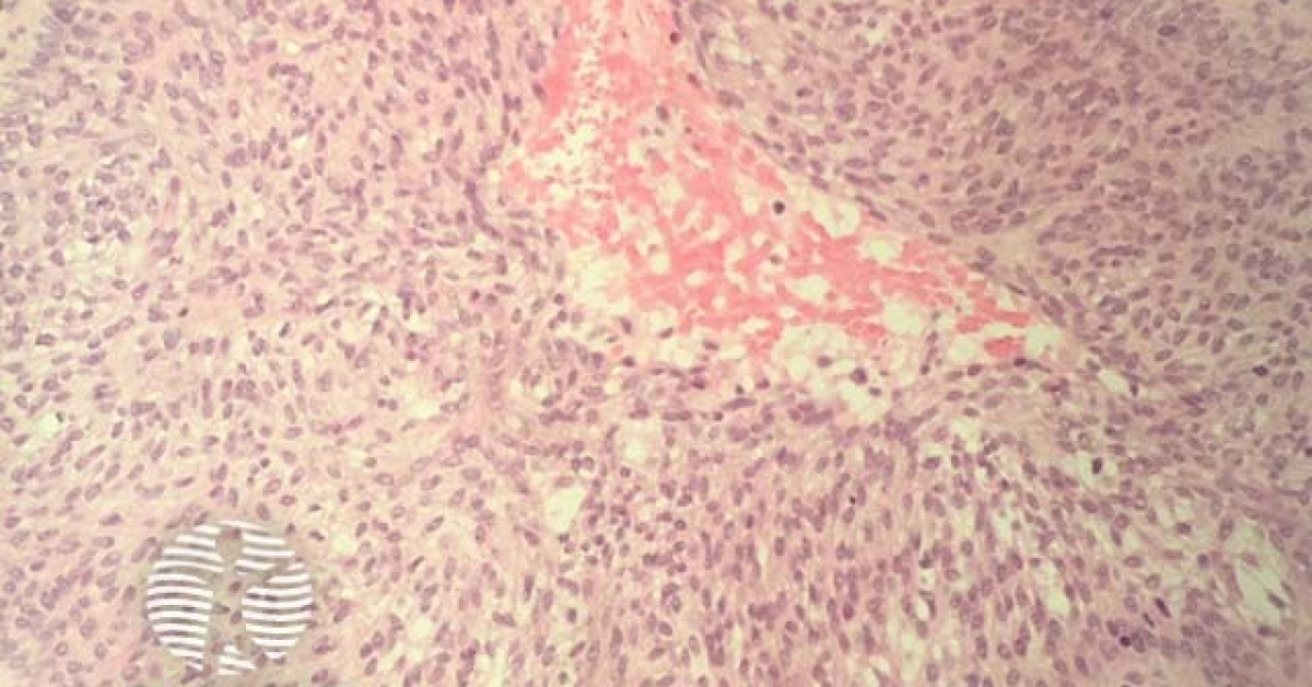 Mycosis fungoides image