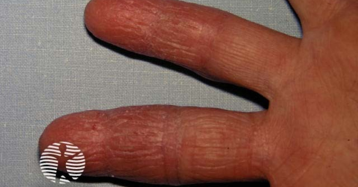 Mycosis fungoides palmaris image
