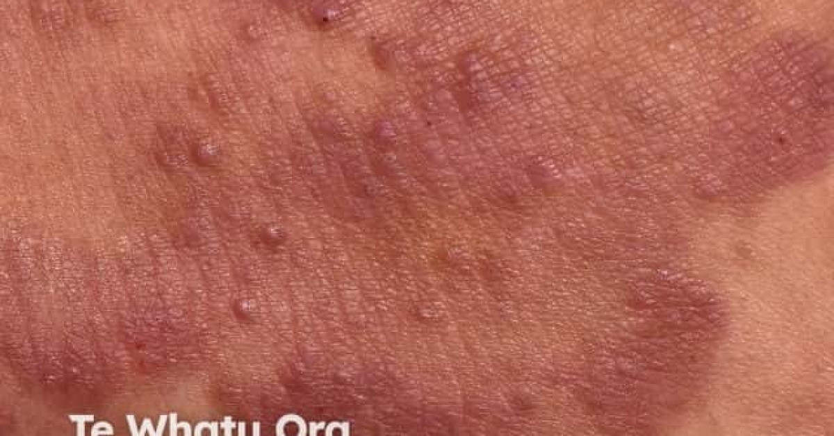 Plaque stage mycosis fungoides image