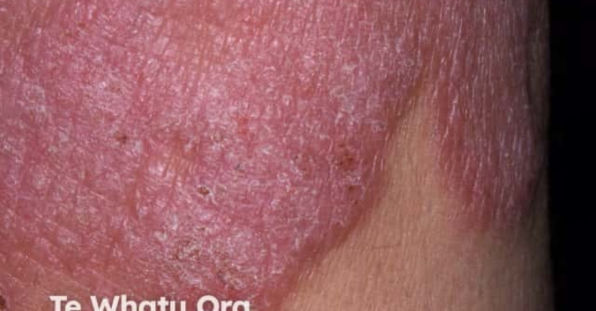 Plaque stage mycosis fungoides image