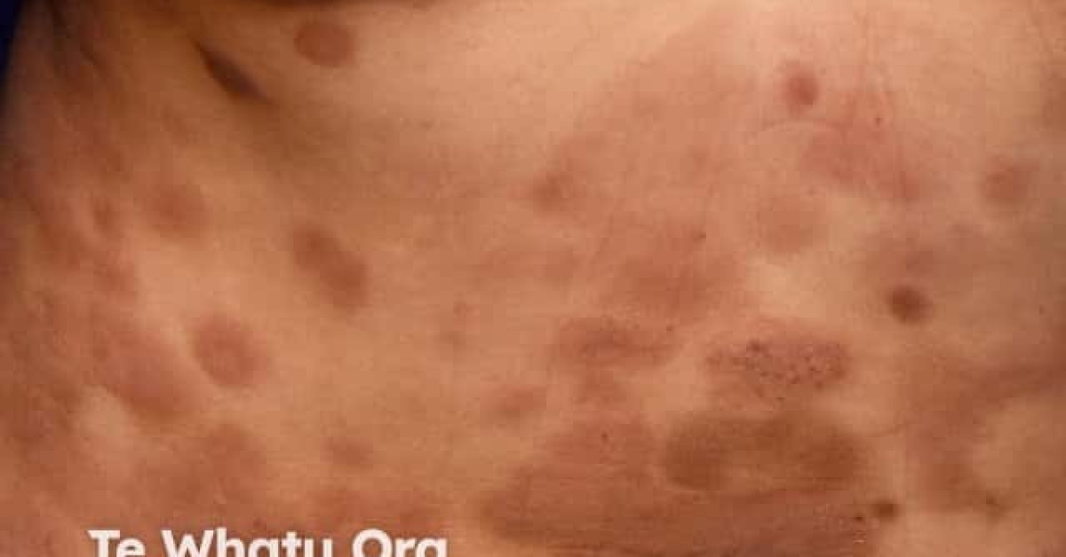 Plaque stage mycosis fungoides image