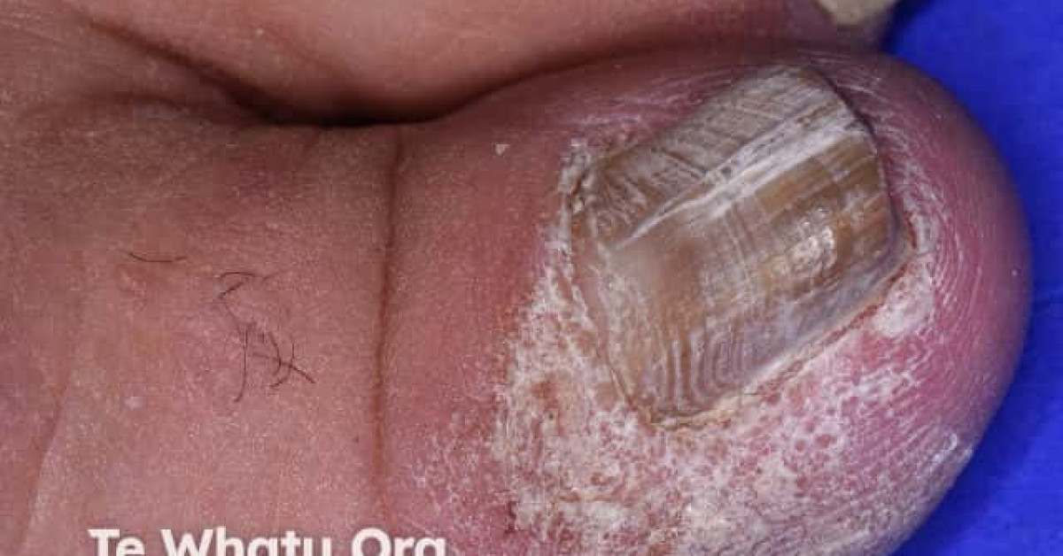 Mycosis fungoides affecting the great toenail image