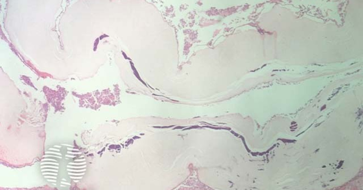 Myiasis pathology image