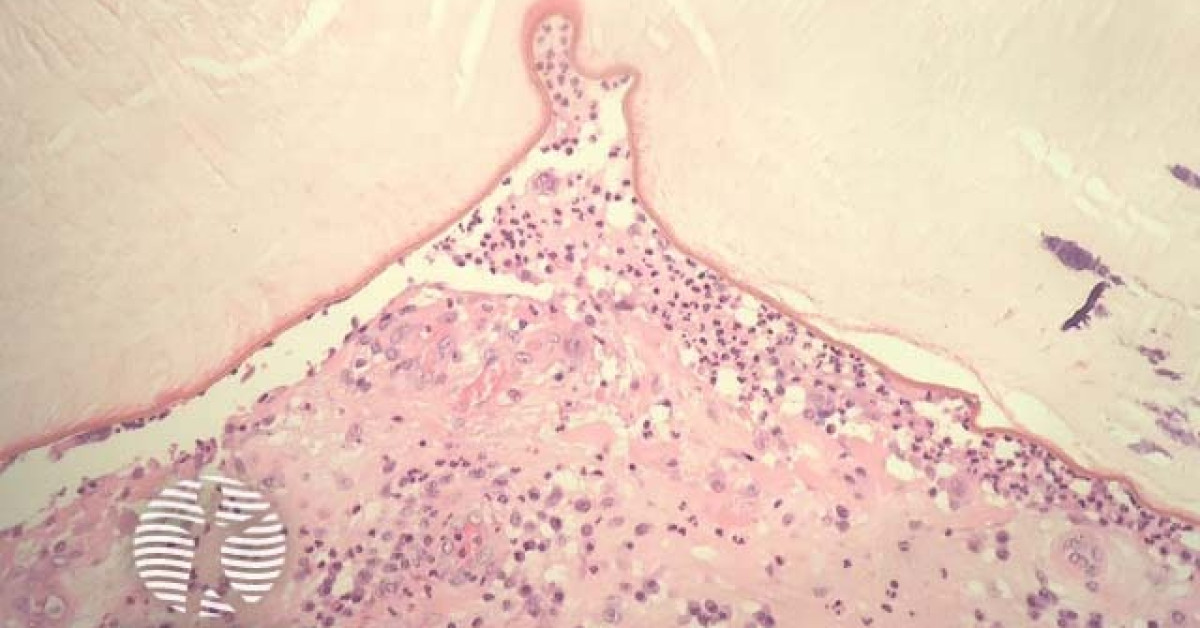DermNet® - Myiasis pathology image