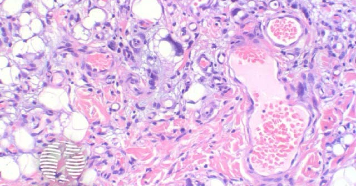 Myxoid liposarcoma pathology image